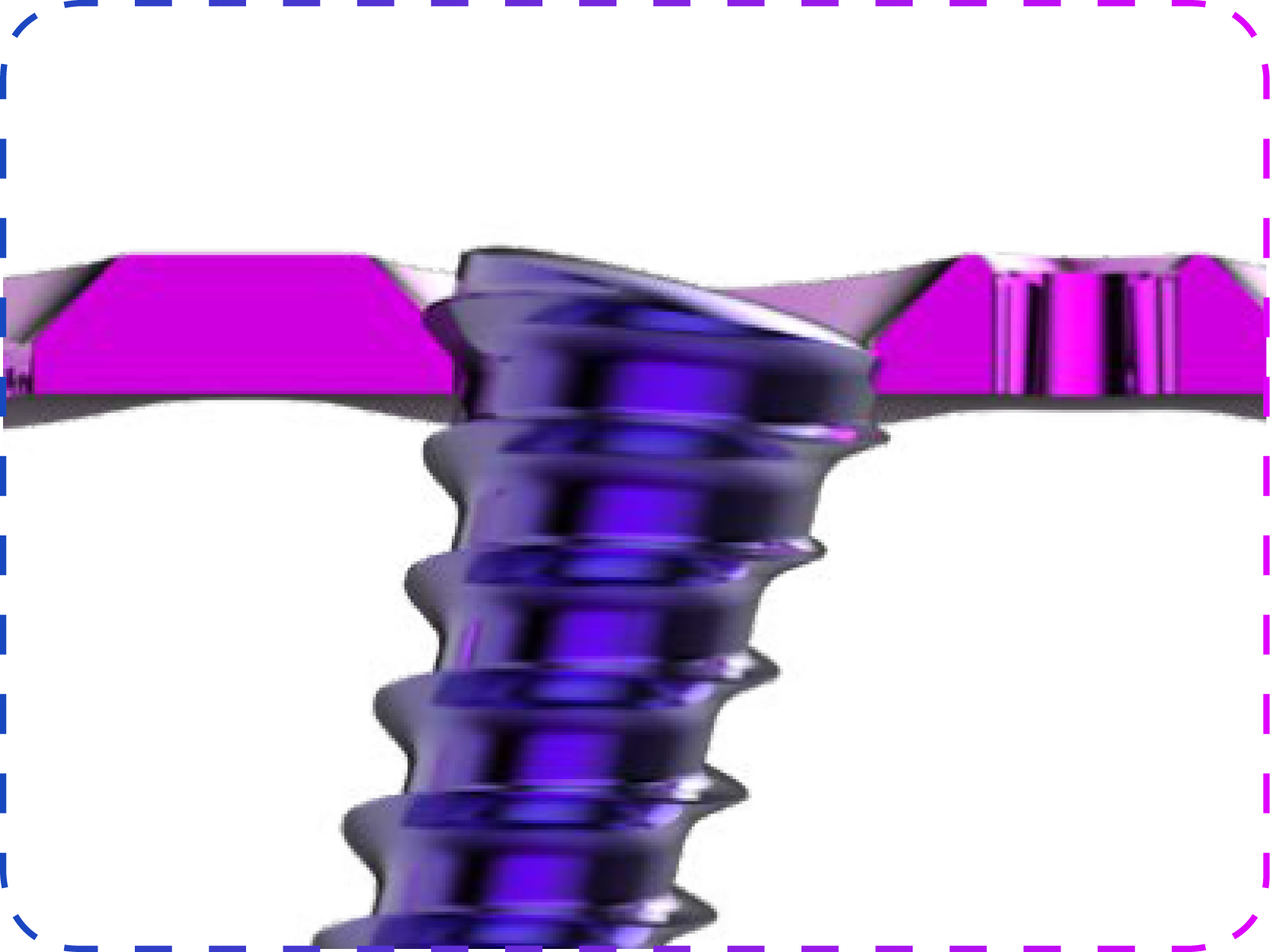 Panda Hand Plating System – Treatment of fractures and reconstructive ...